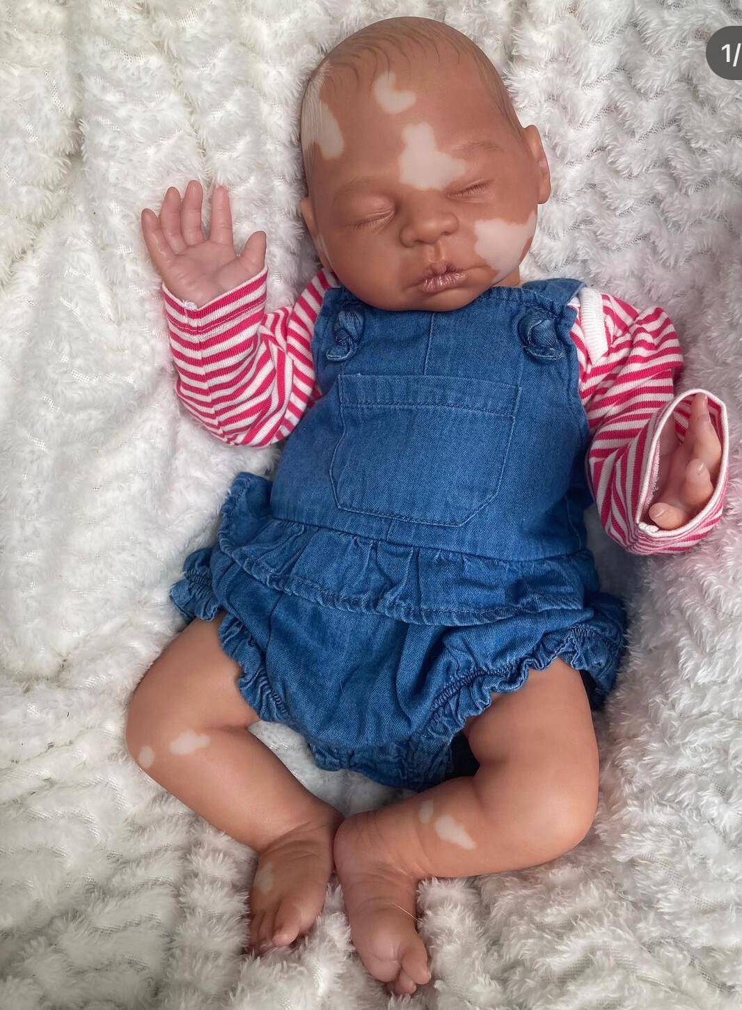Can someone help me please, vitiligo! - Baby Talk - Bountiful Baby ...